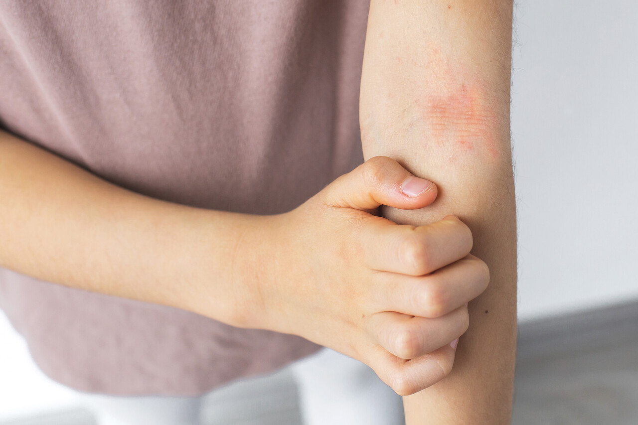 Multiple Eczema Types? Why One Treatment May Not Be Enough