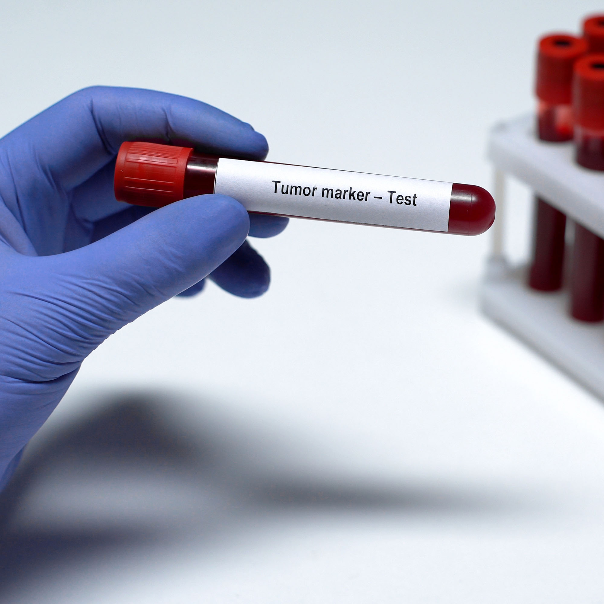 Tests to Expect in MBC Treatment