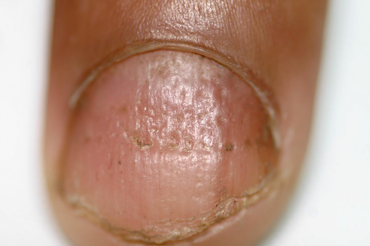 What Is Considered Mild Psoriasis: Types, Pictures, and Treatment