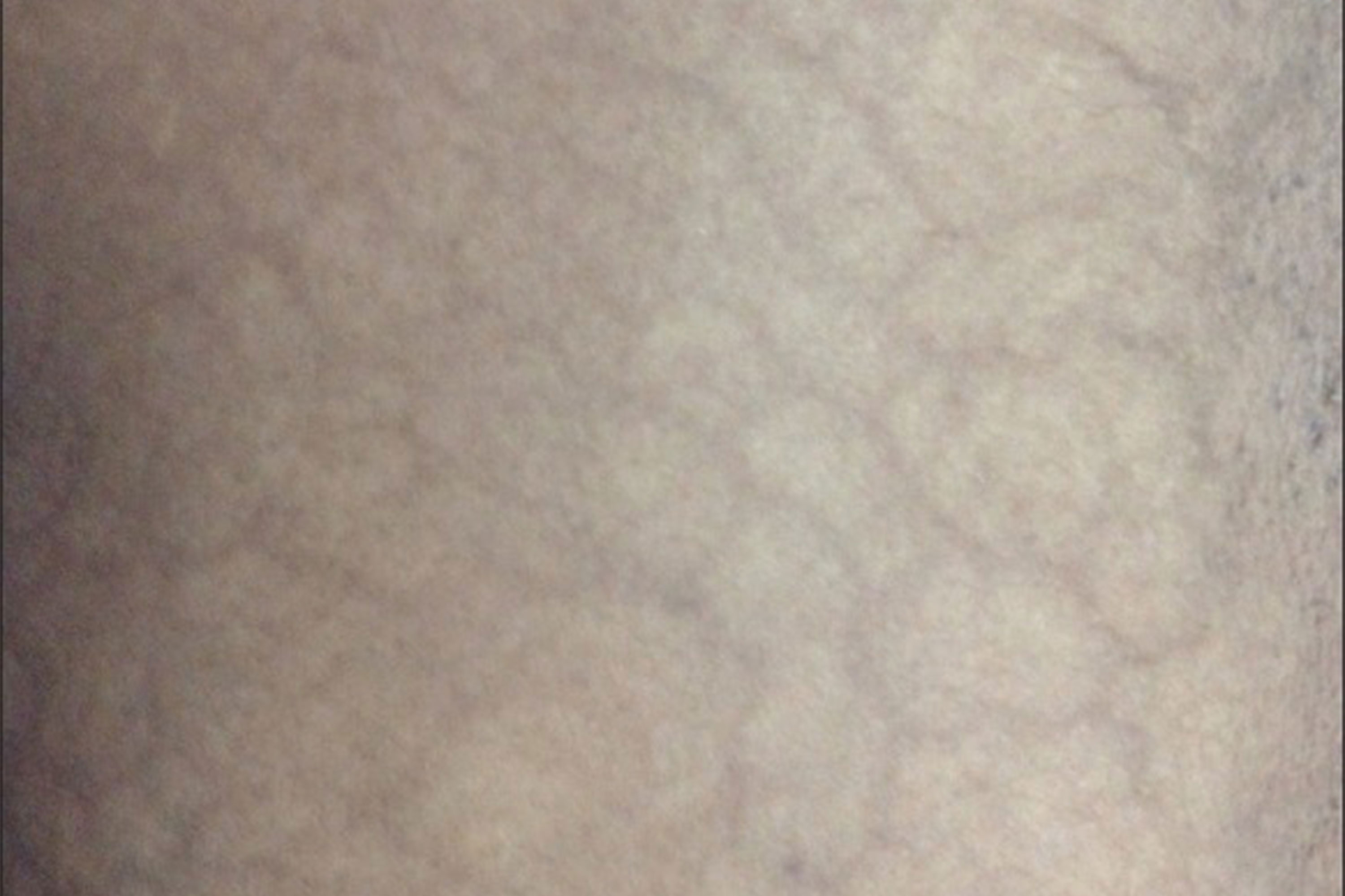 Rheumatoid Arthritis Rashes: Pictures, Causes, and Treatment