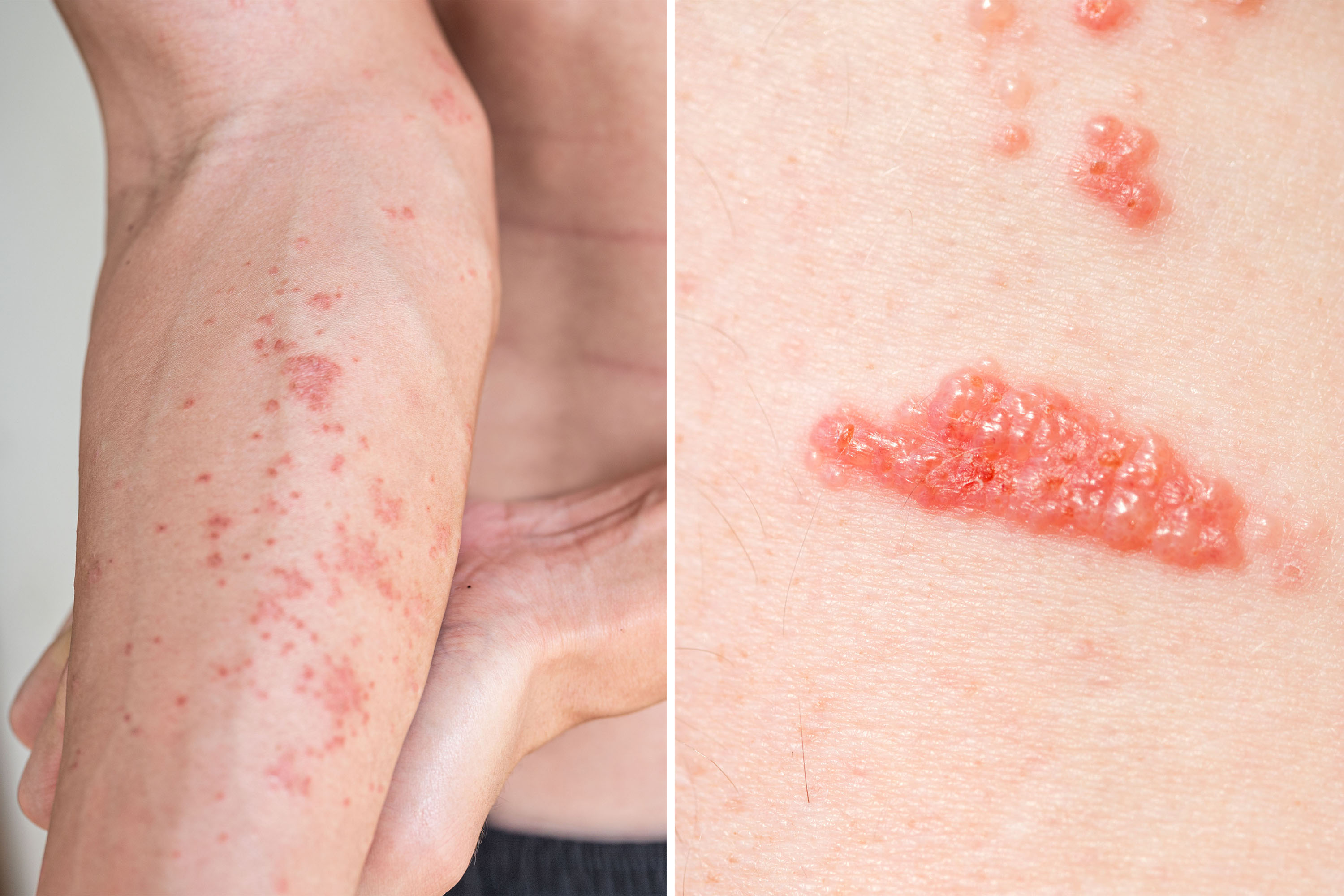 Contact Dermatitis Blisters