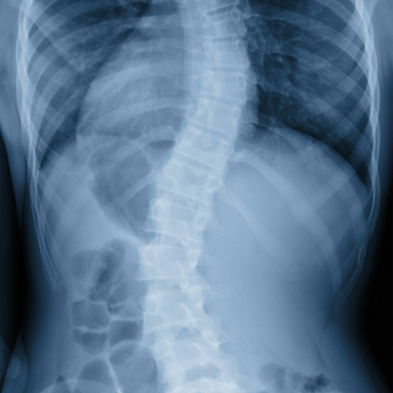 Possible Complications From Spinal Muscular Atrophy