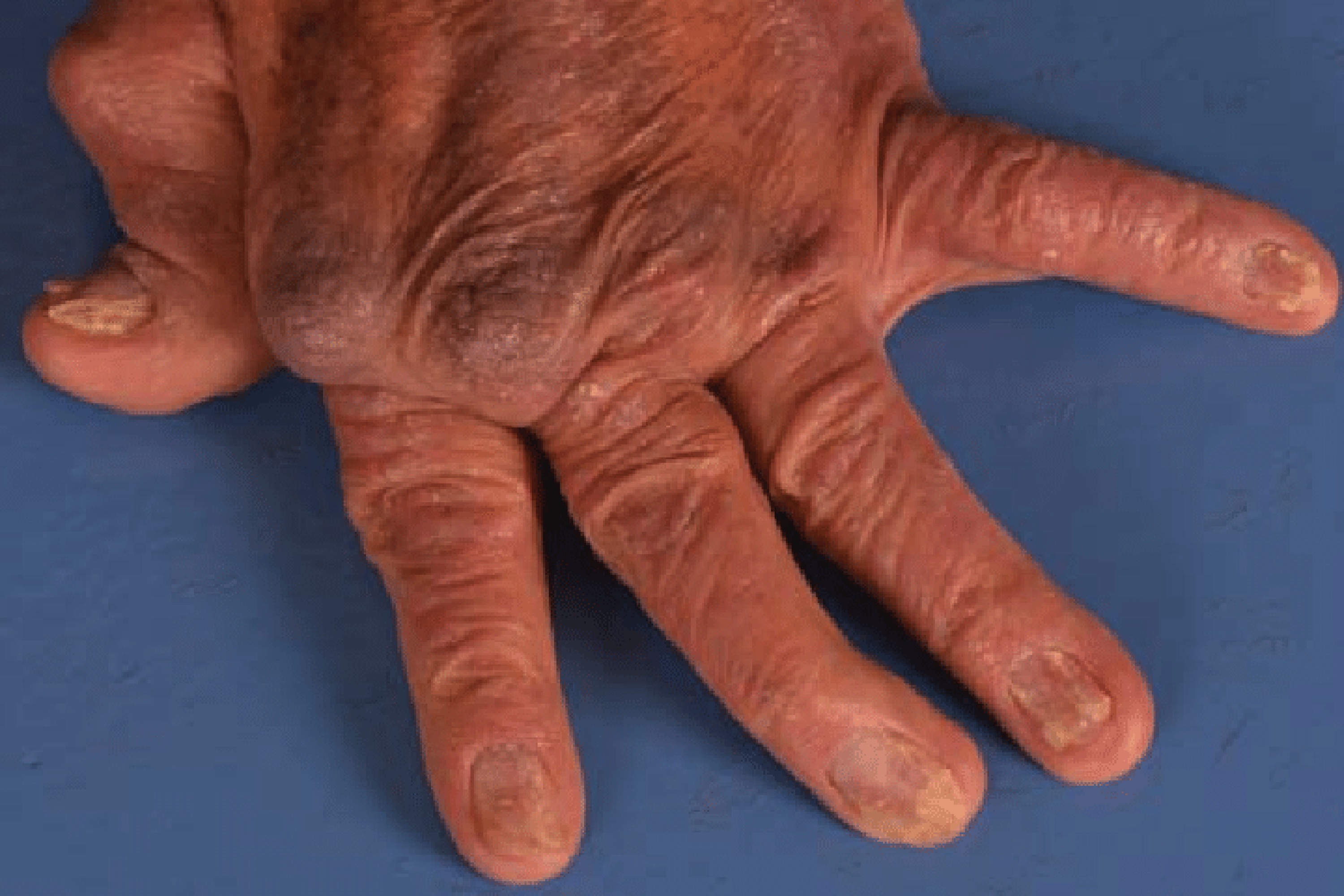 Psoriatic Arthritis Mutilans: Pictures, Symptoms, and More
