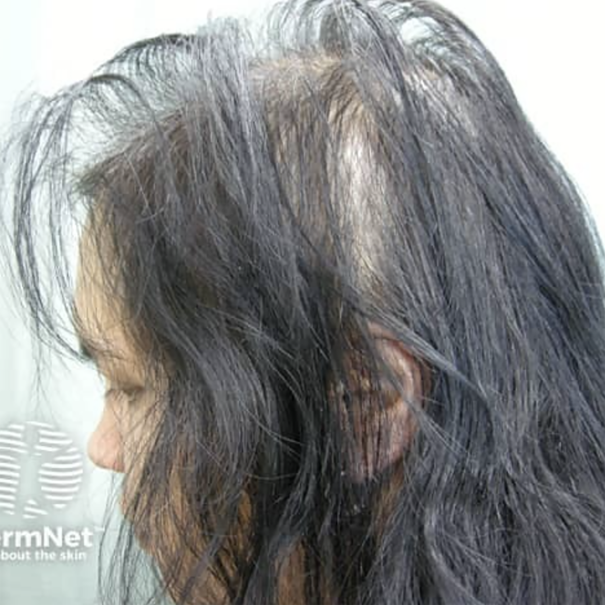 Alopecia Areata In Women Hair Loss In Women Pennsylvania Dermatology