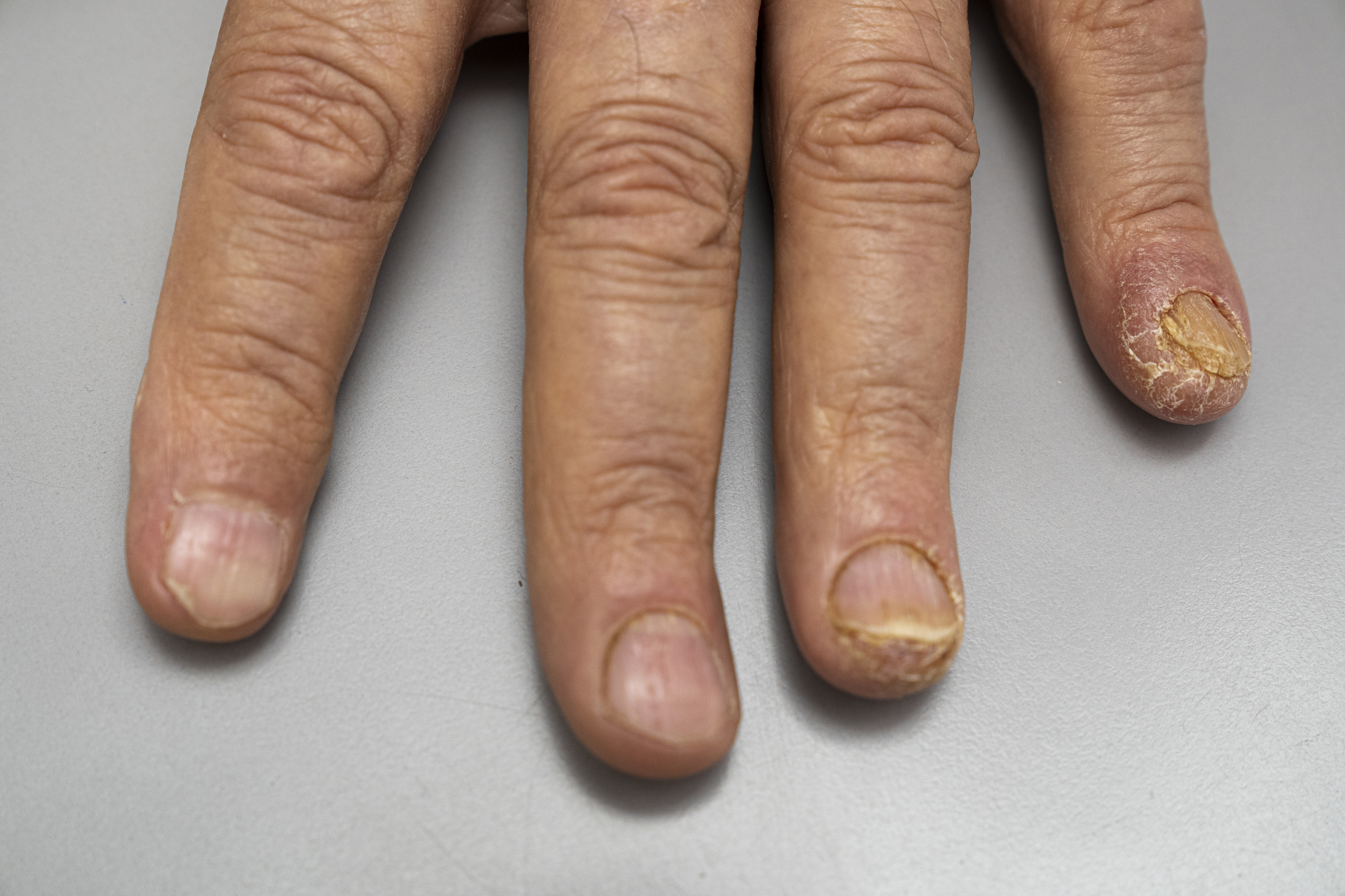 Can You Spot Psoriatic Arthritis Sooner? Intriguing New Findings