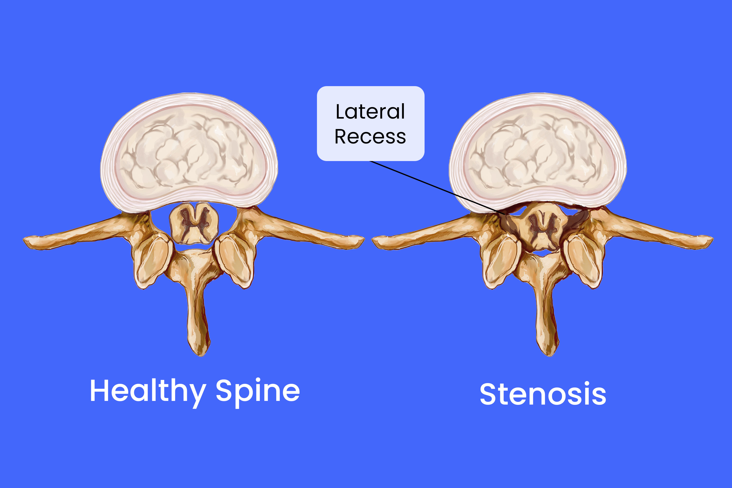 Lateral Recess Stenosis: Symptoms, Causes, and Treatment
