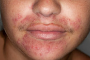 Skin Rash On Mouth Corner Infoupdate Skin Rash On Mouth Corner Infoupdate
