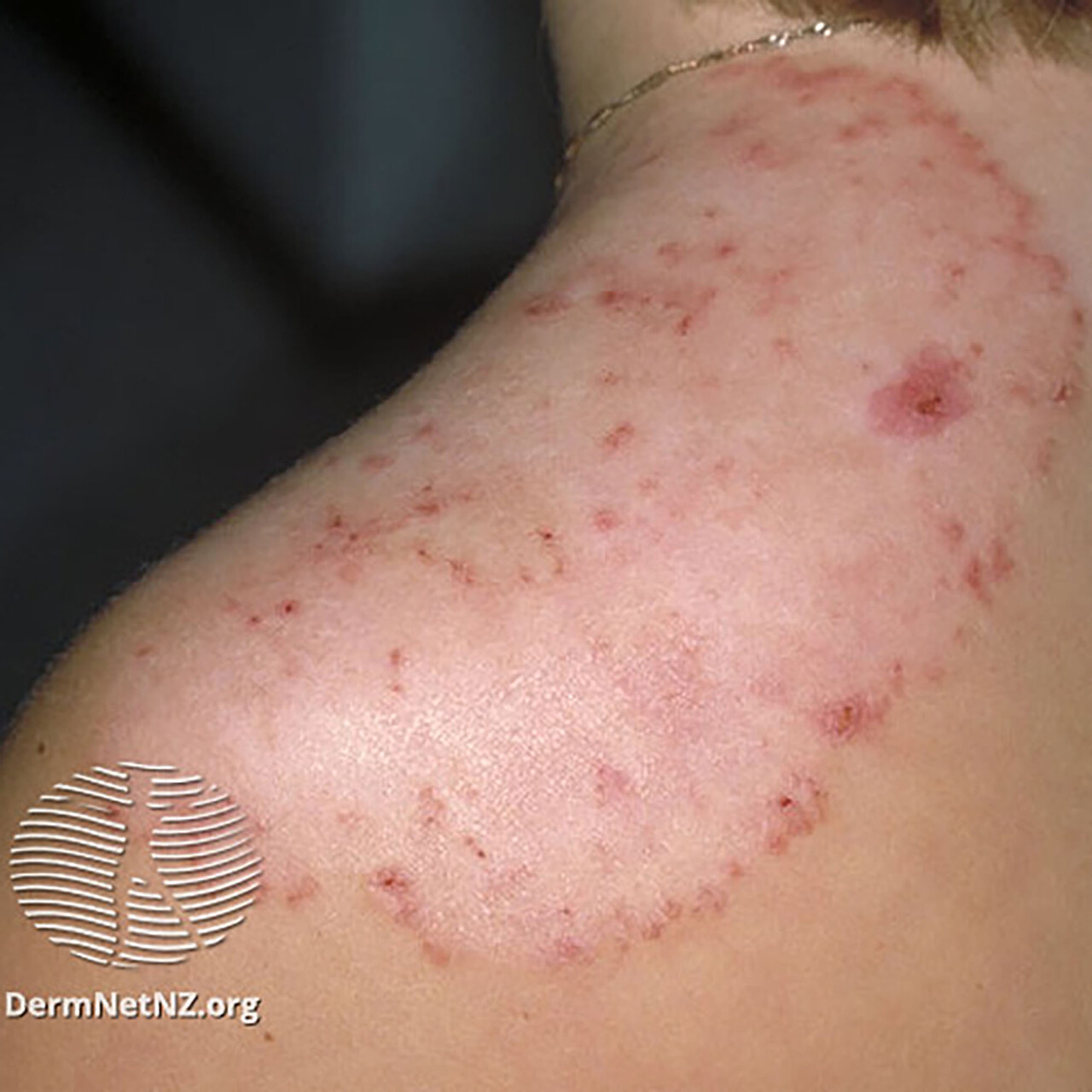 What Can Be Mistaken For Shingles?