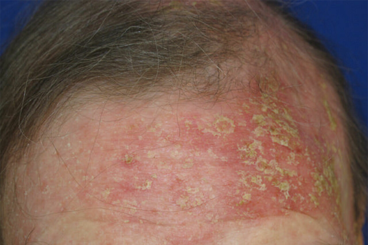 Sebopsoriasis: Causes, Symptoms, and Treatment Explained