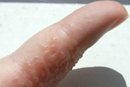 Eczema Blisters On Hands Eczema Blisters On Hands