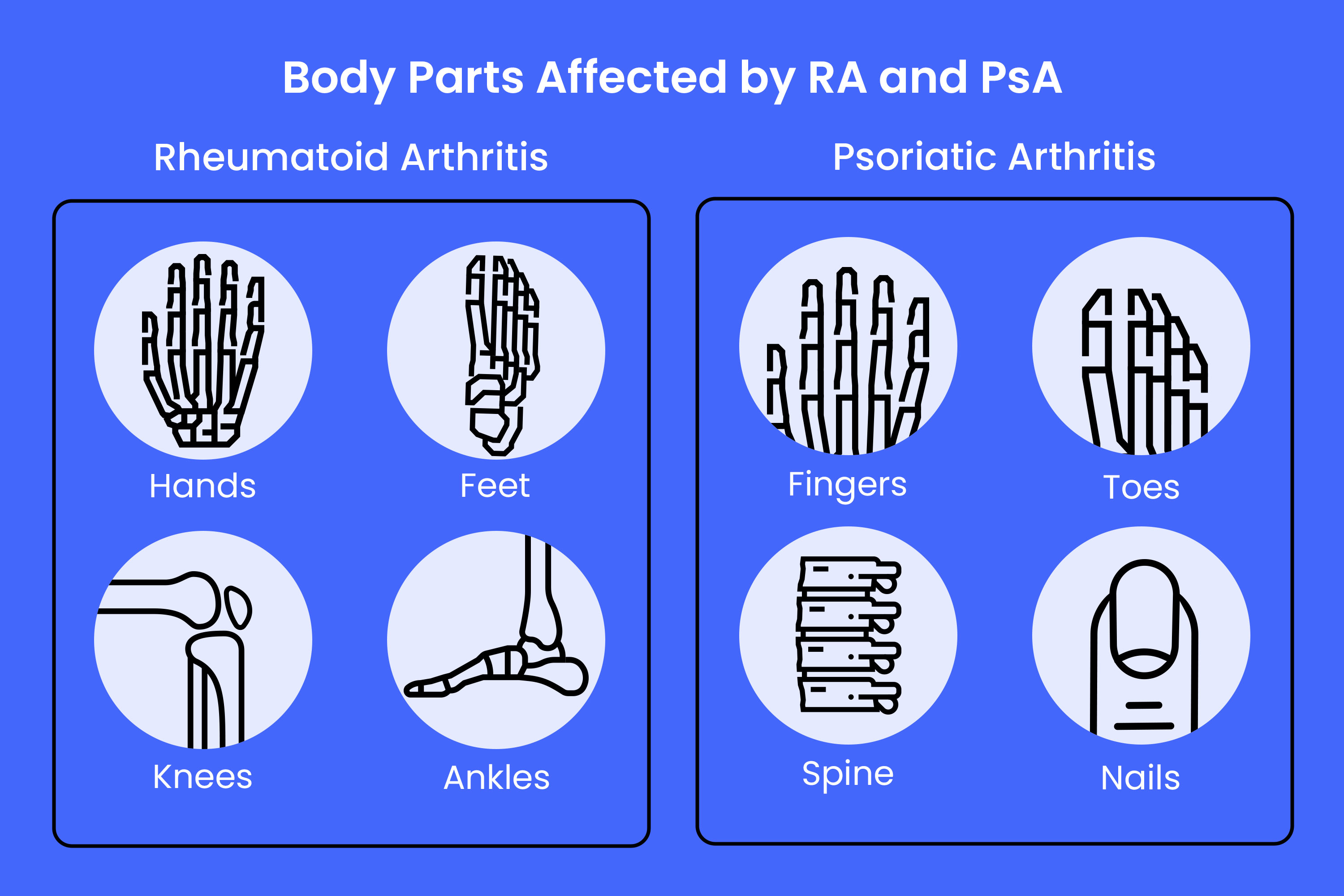 Psoriatic Arthritis Vs Rheumatoid Arthritis Key Differences Explained