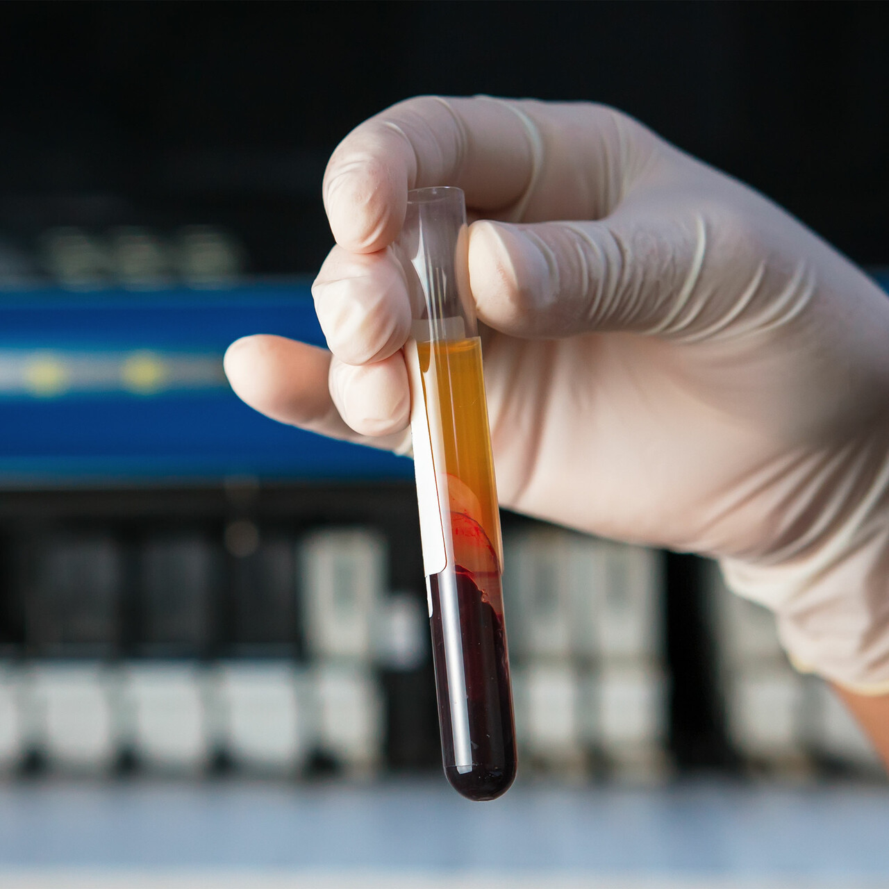 Common Tests You May Have for Ulcerative Colitis