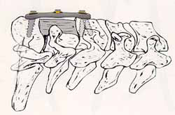 Cervical Plates: Provide Neck Stability Using Spinal Instrumentation