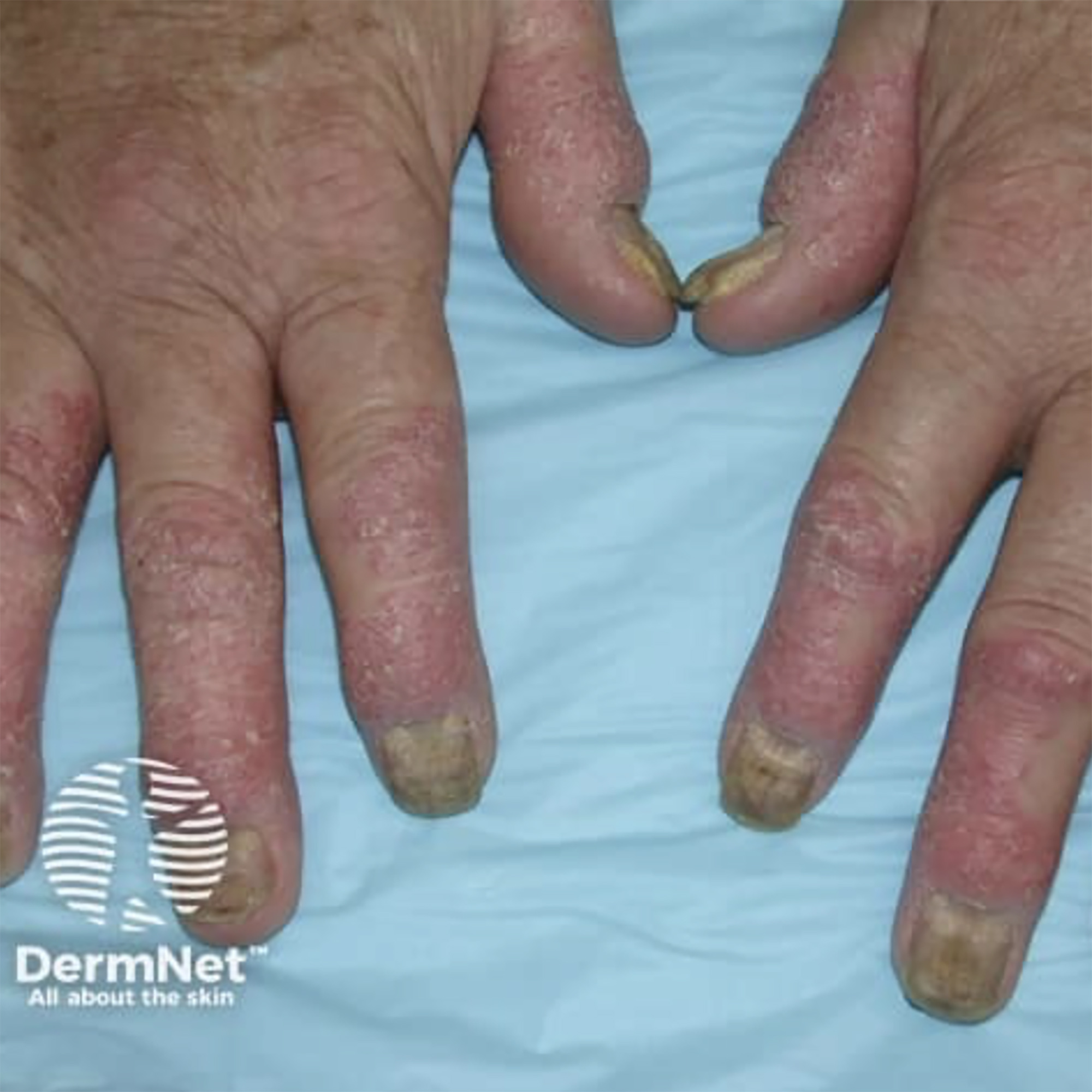 What Does Psoriatic Arthritis Look Like? Symptoms, Skin Changes, and ...