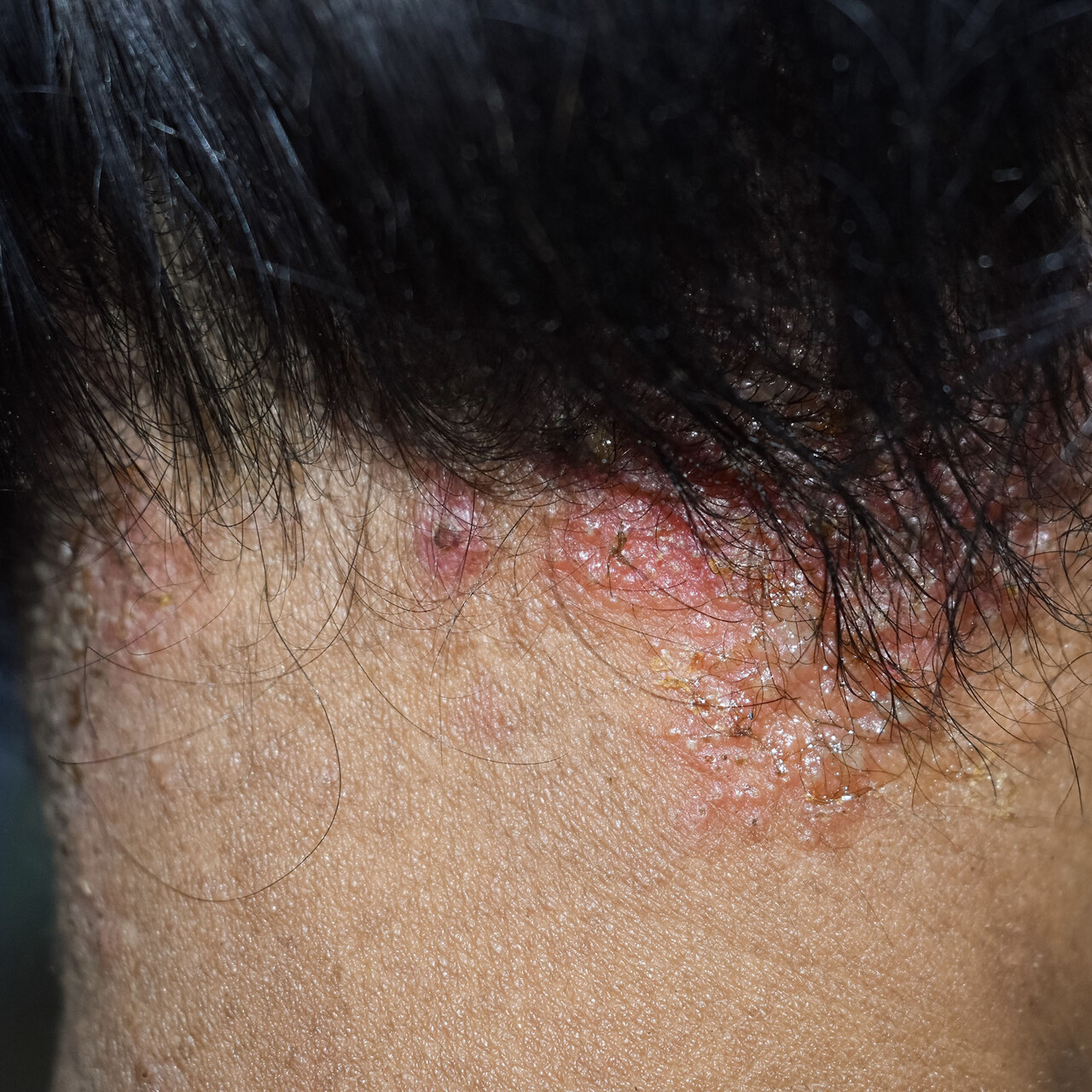 Understanding Light Therapy for Scalp Psoriasis