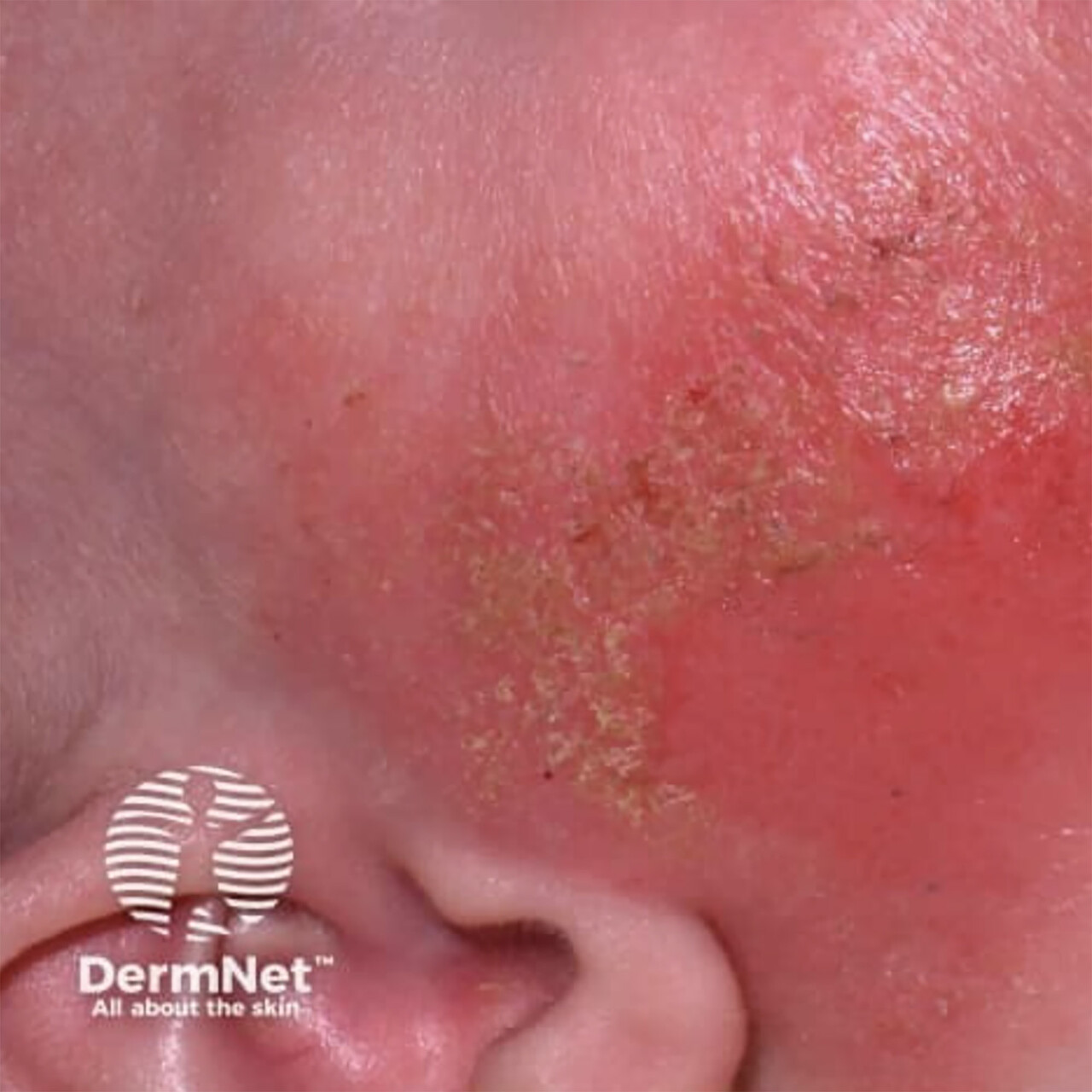 Pictures of Eczema: A Visual Guide