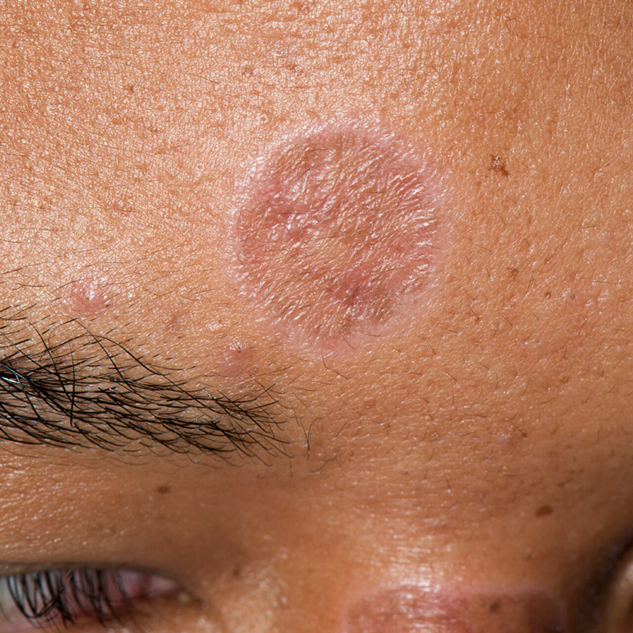 Butterfly Rash On Chest