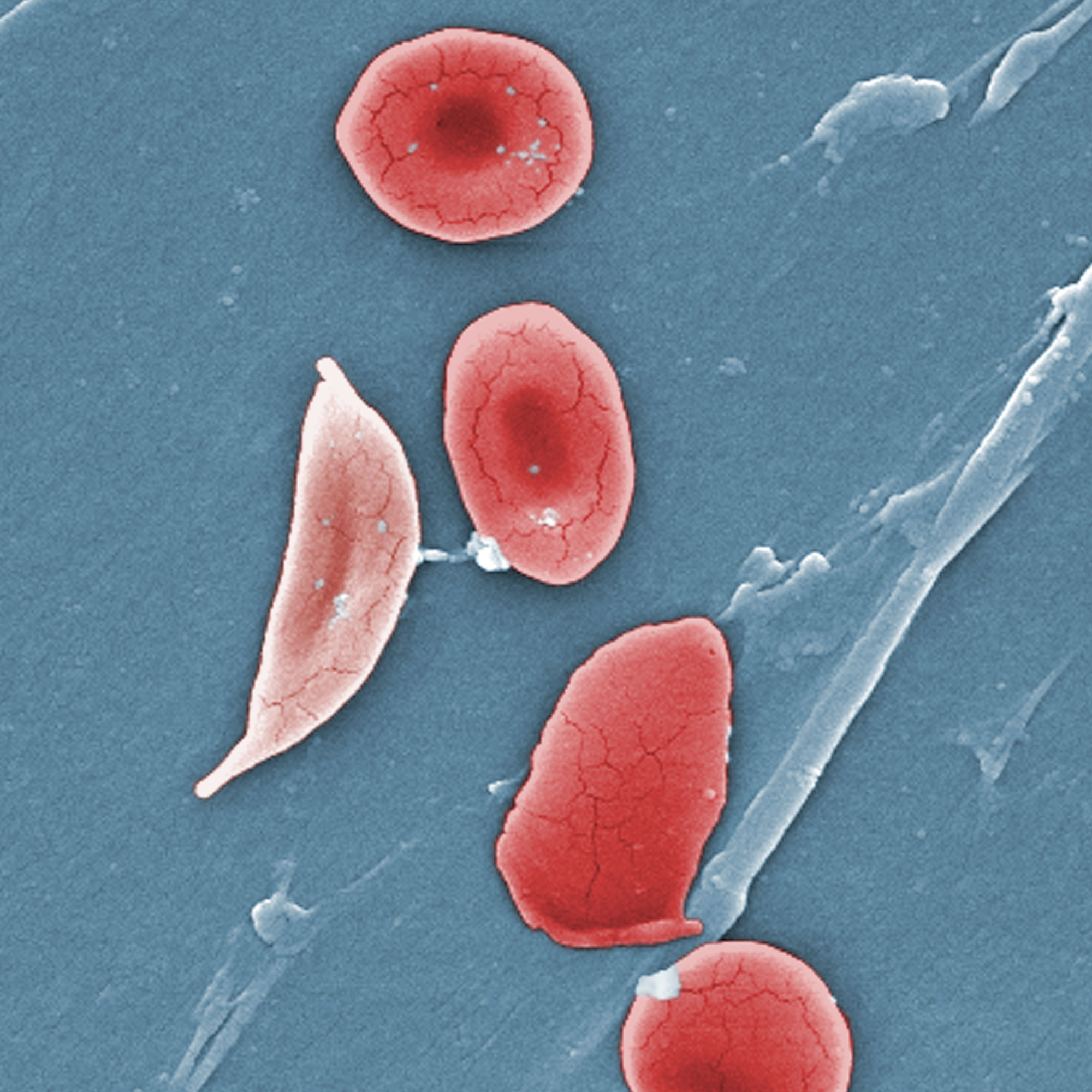 How Do Cells Sickle, Anyway?