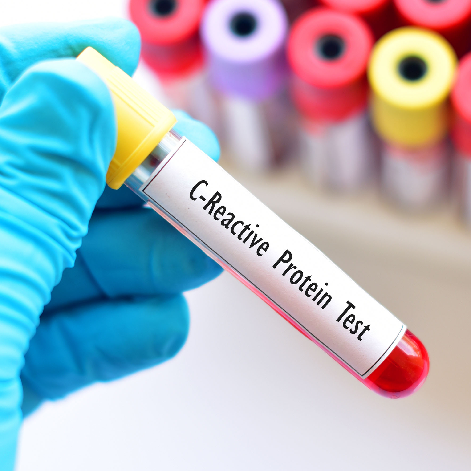 How to Tell If Your Ulcerative Colitis Is in Remission