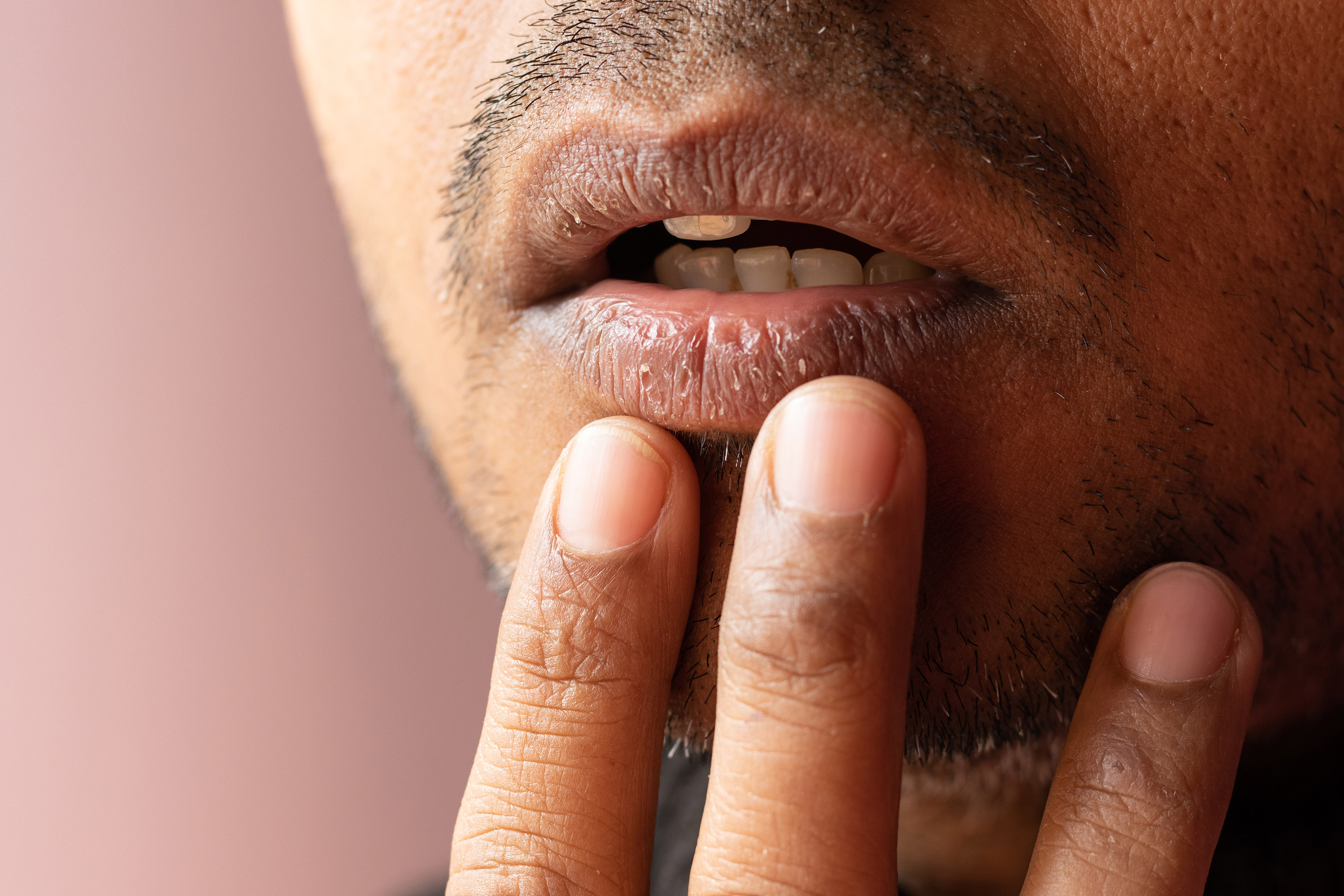 Eczema on Lips: Causes, Symptoms, and Treatment Options