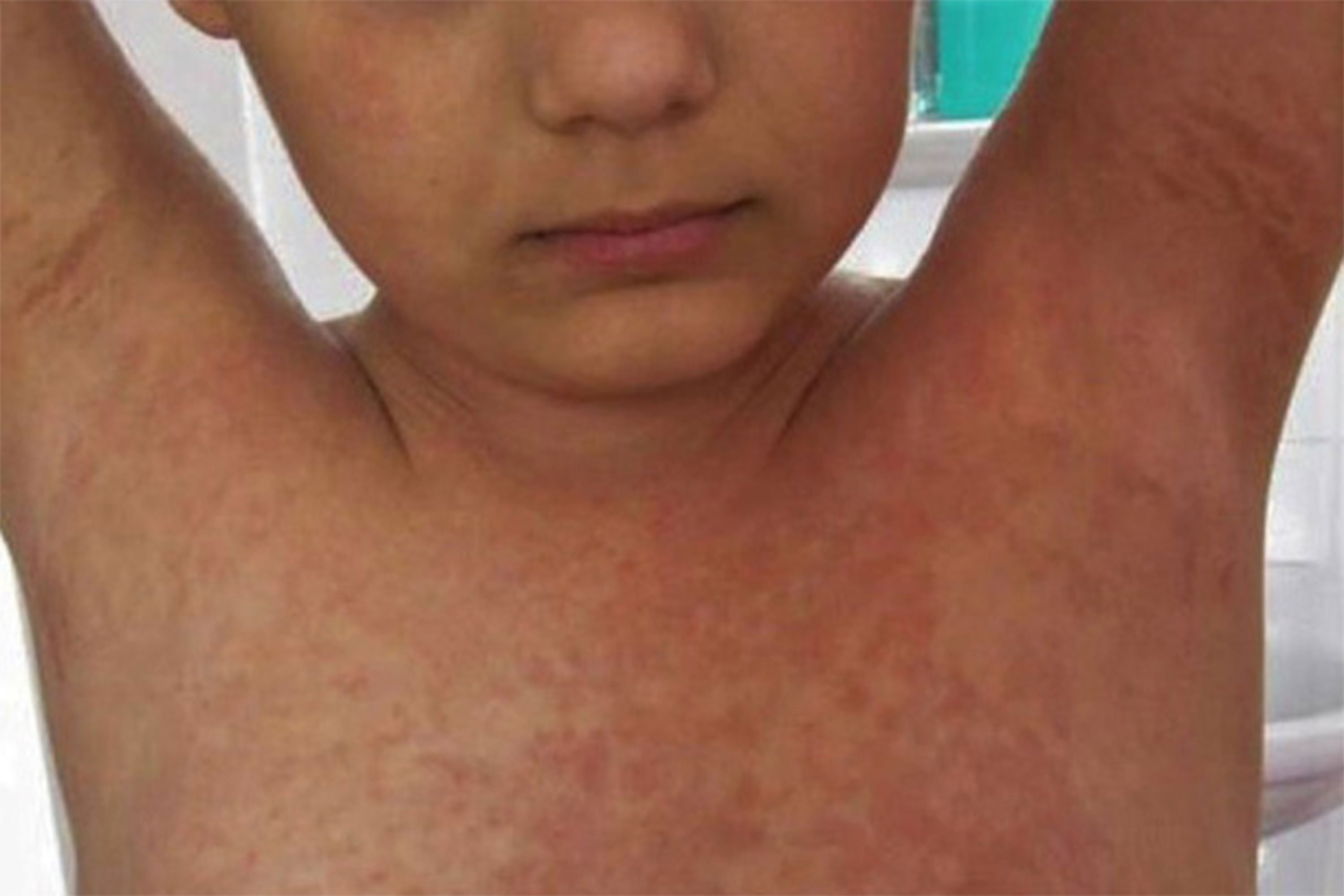 Mild Psoriasis Chest