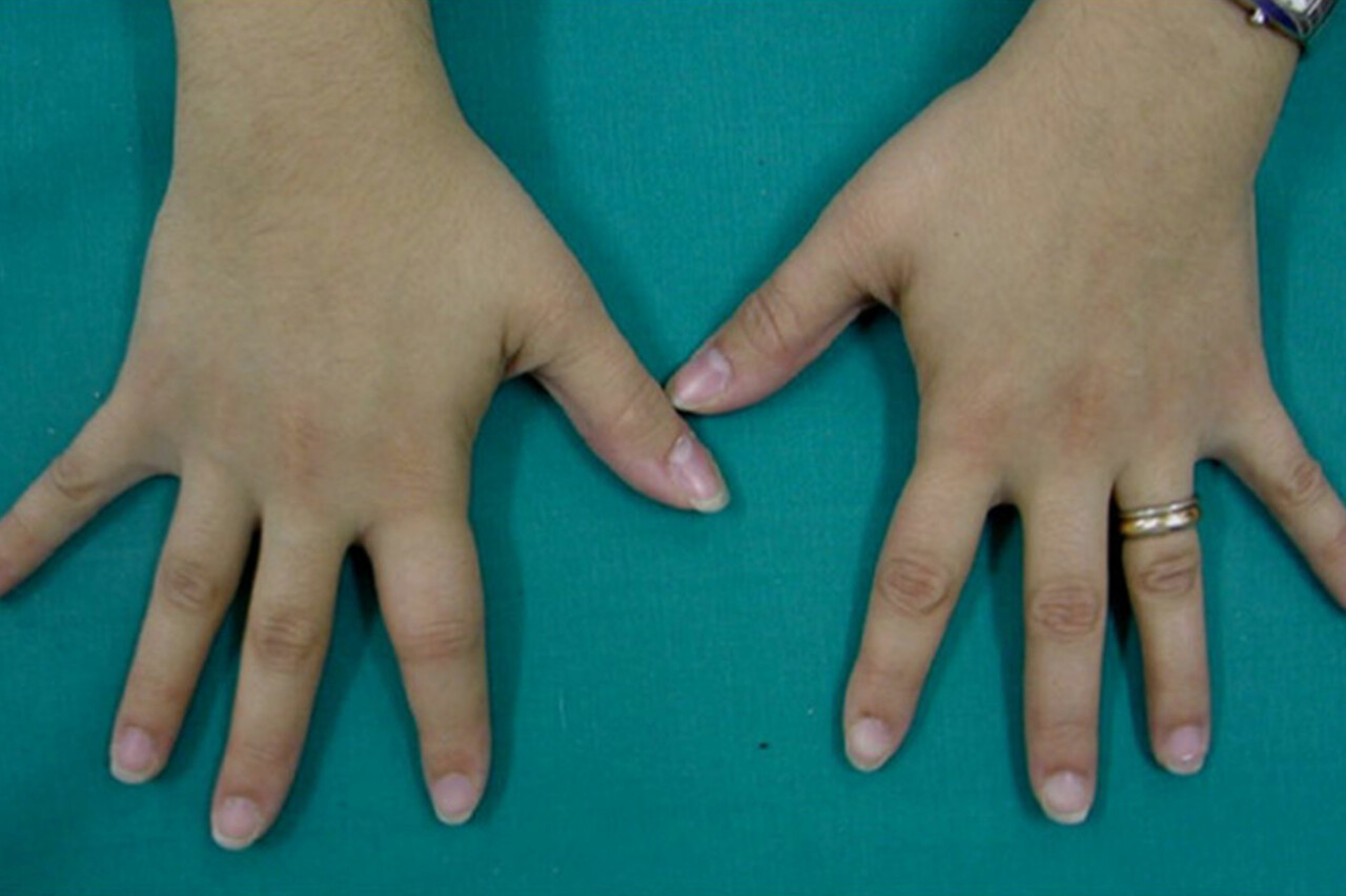 Types of Psoriatic Arthritis