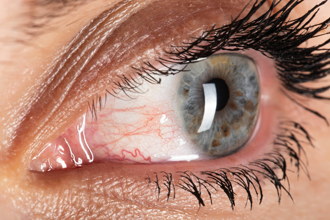 How Does Psoriatic Arthritis Affect the Eyes?