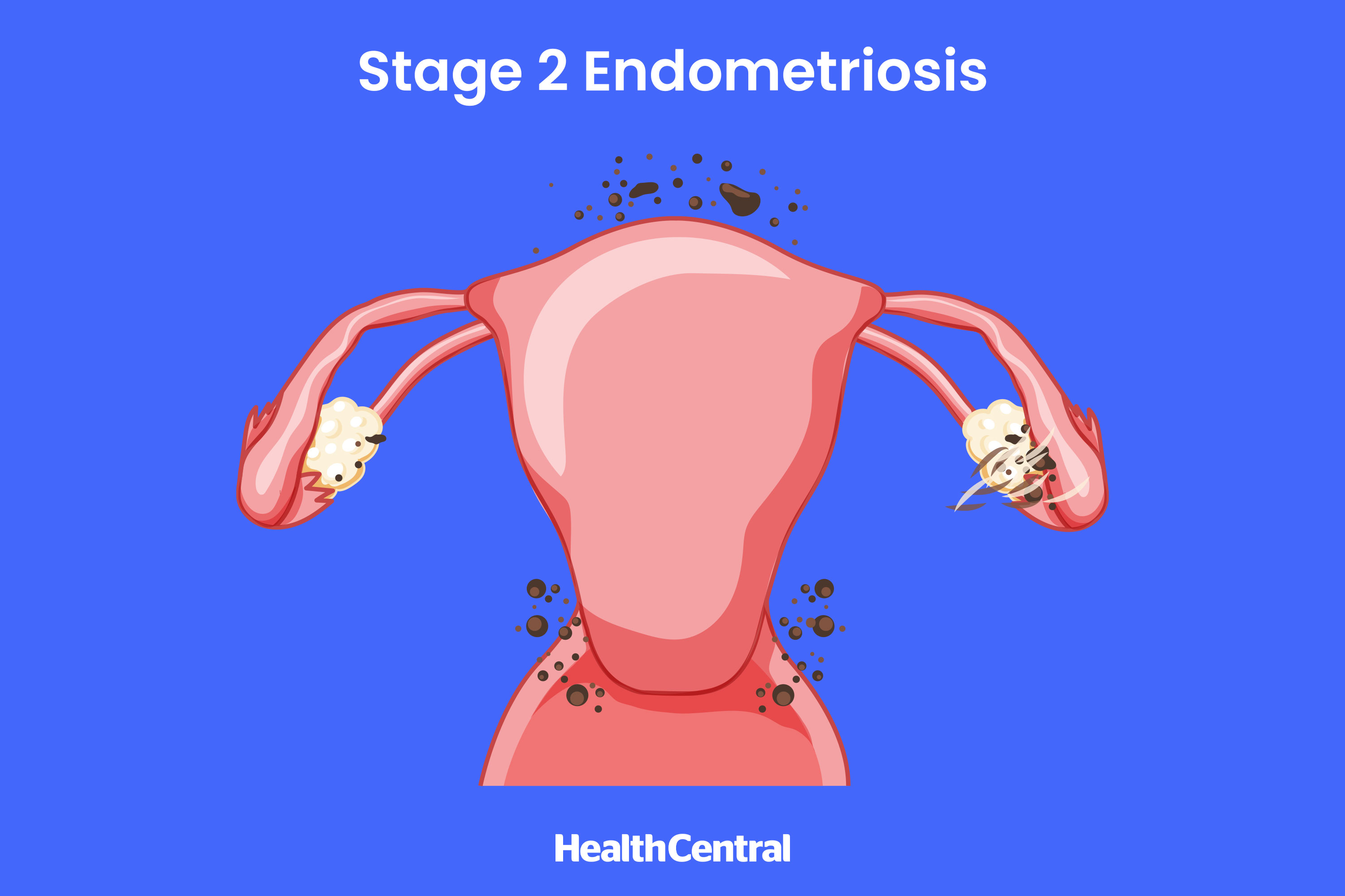 Pictures of Endometriosis: Visual Guide