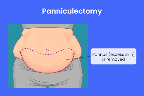 What Is Panniculectomy Surgery?
