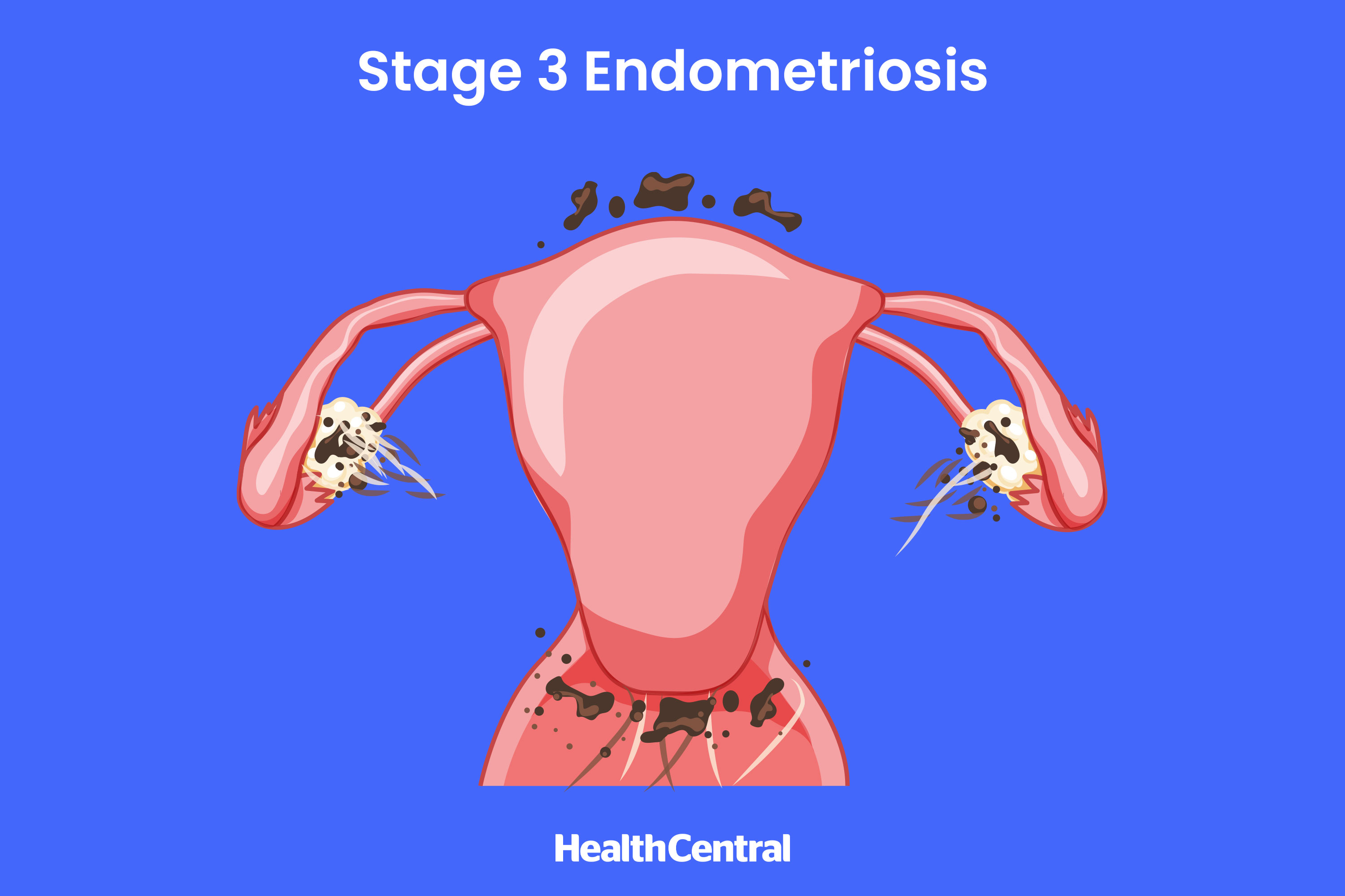 Pictures of Endometriosis: Visual Guide