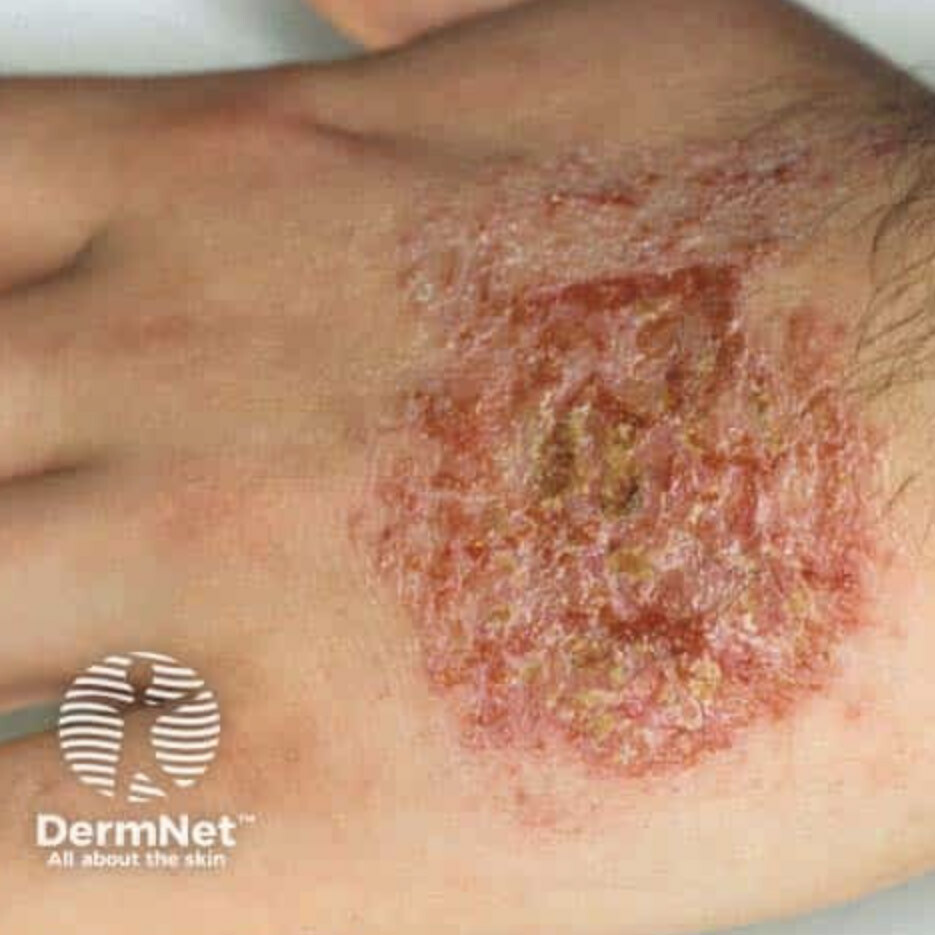 Pictures of Eczema: A Visual Guide