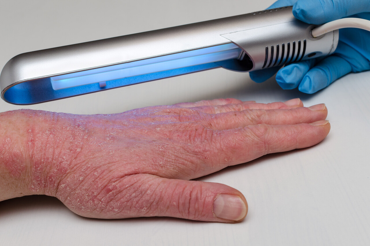 Light Therapy for Psoriasis: Types, Purpose, & More