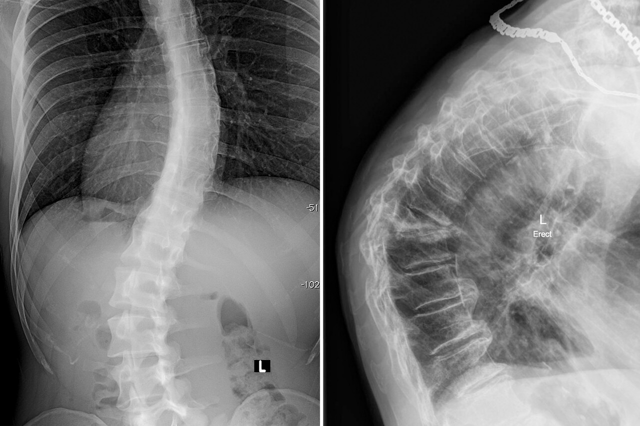 Scoliosis and Kyphosis: What’s the Difference?