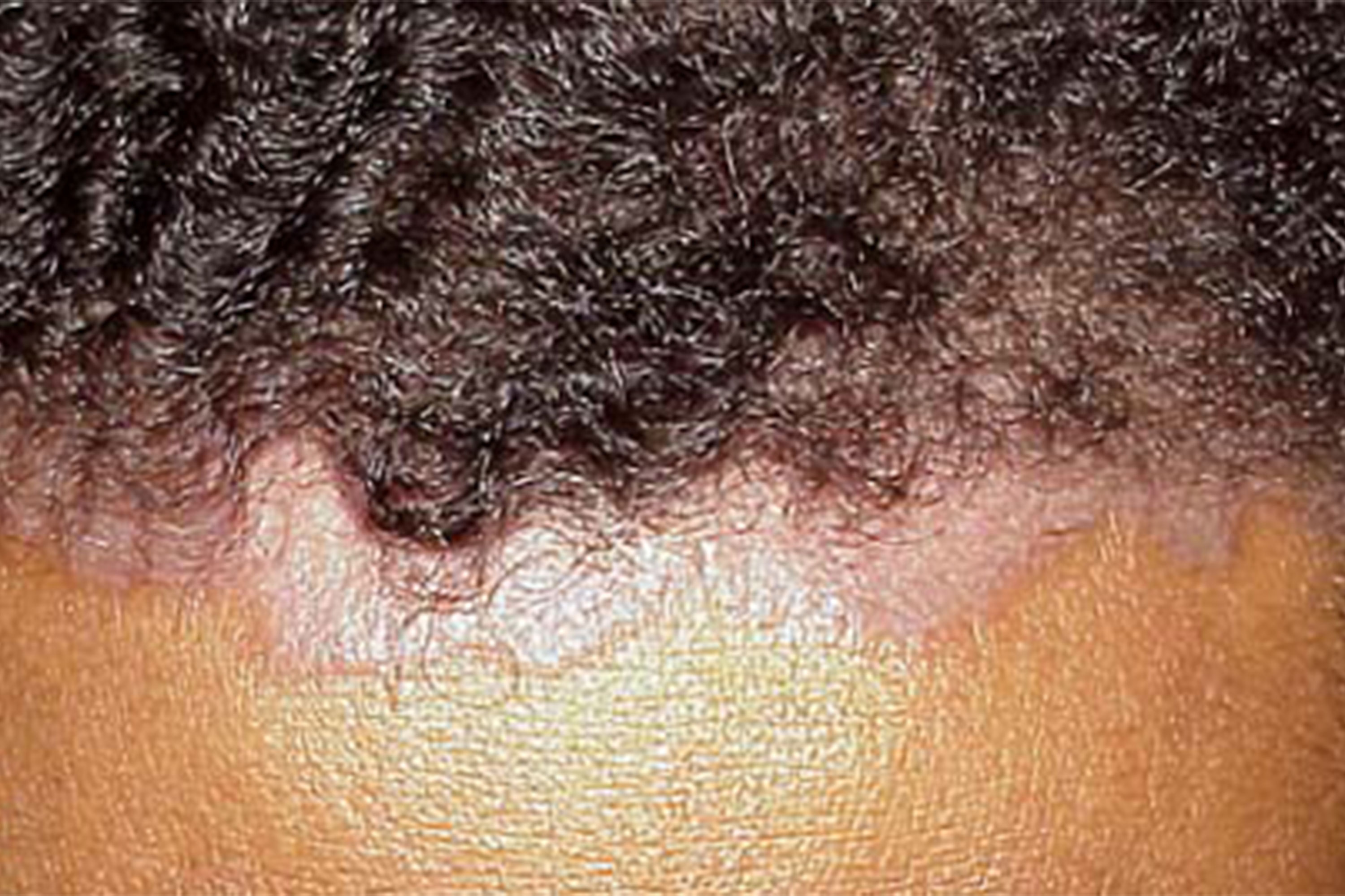 Eczema Types: Dyshidrotic, Seborrheic, Nummular and More