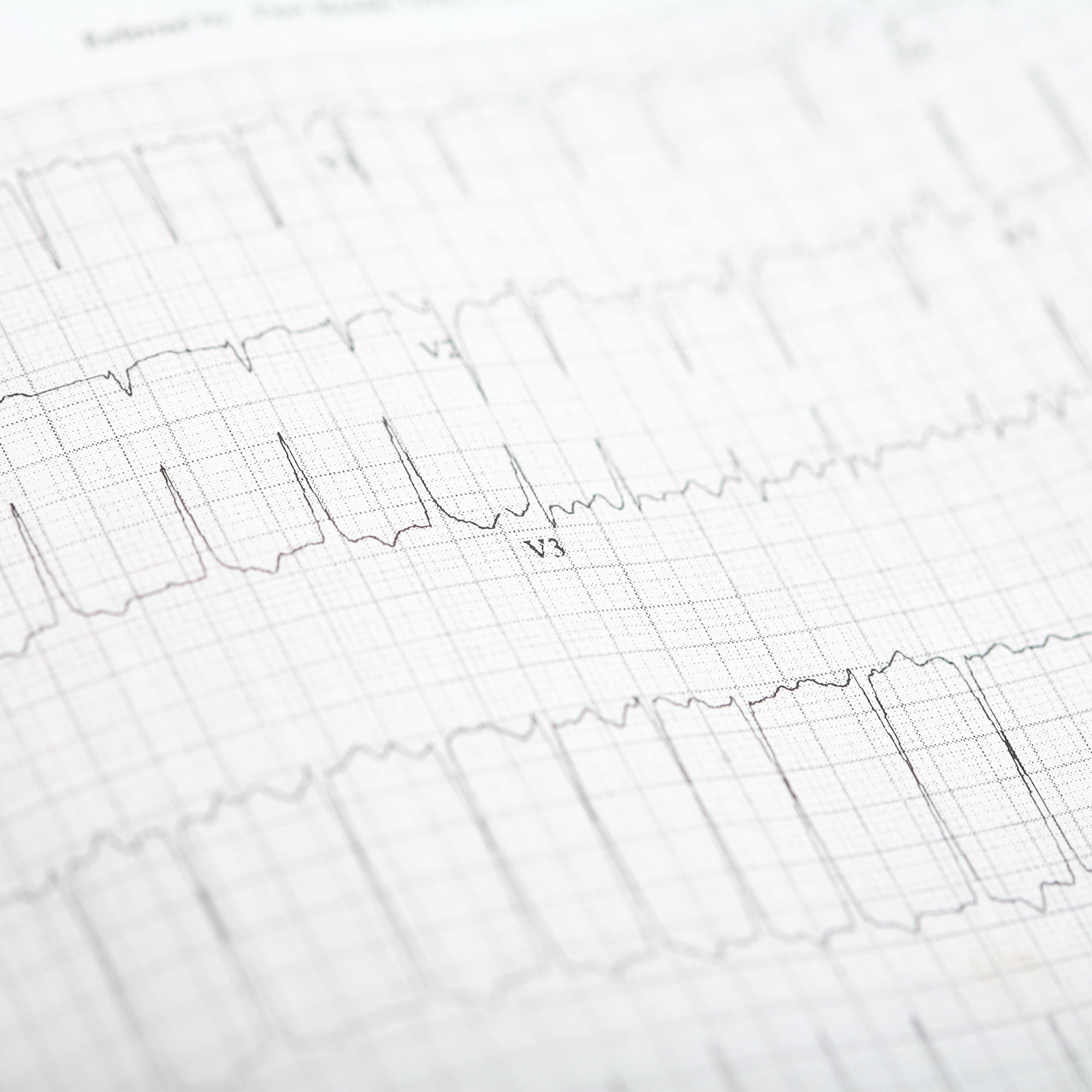 The Latest Thinking on Treating Afib