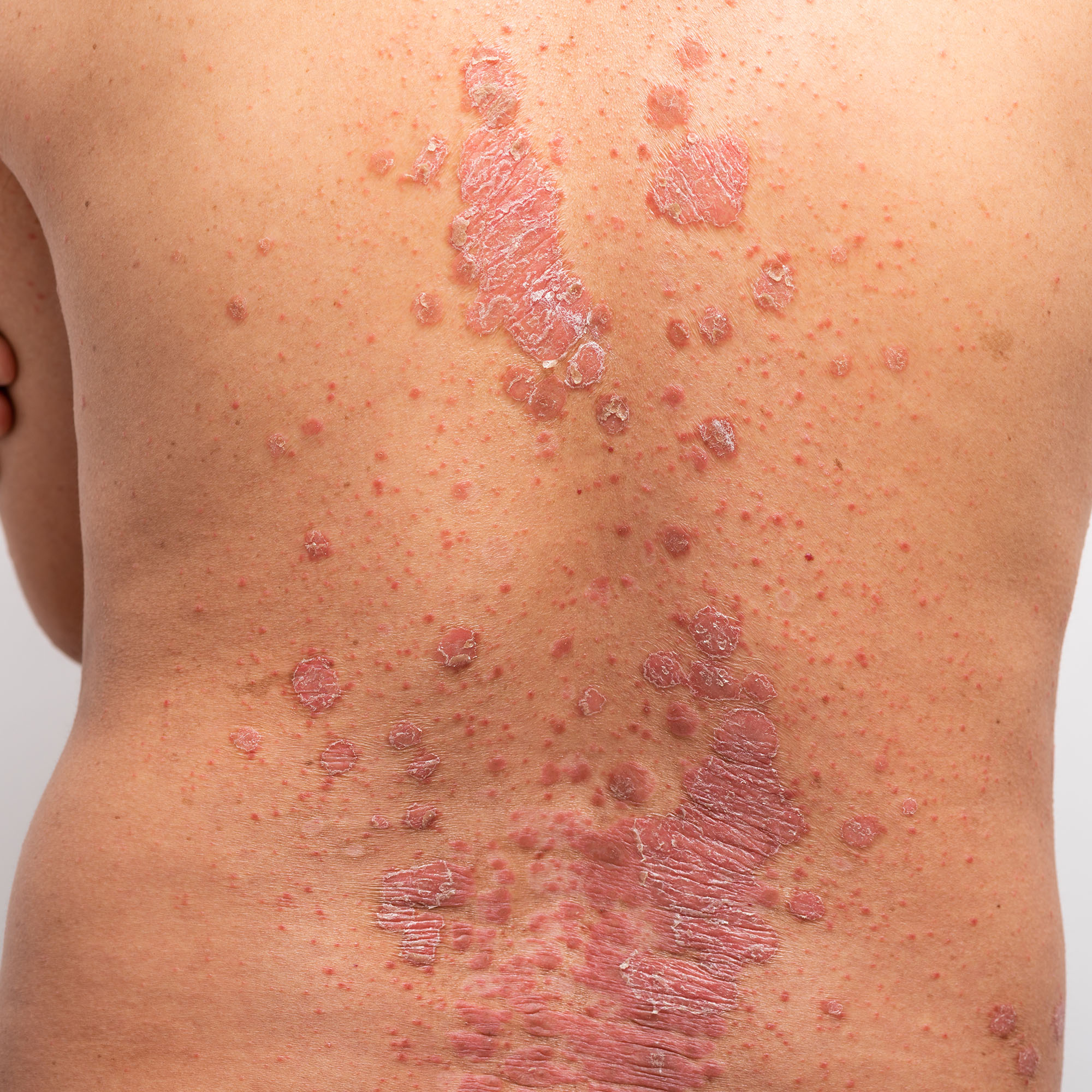 What Is a Severe Psoriasis Flare Like?
