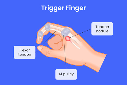 Trigger Finger Definition Etiology Symptoms Diagnosis Evaluation And