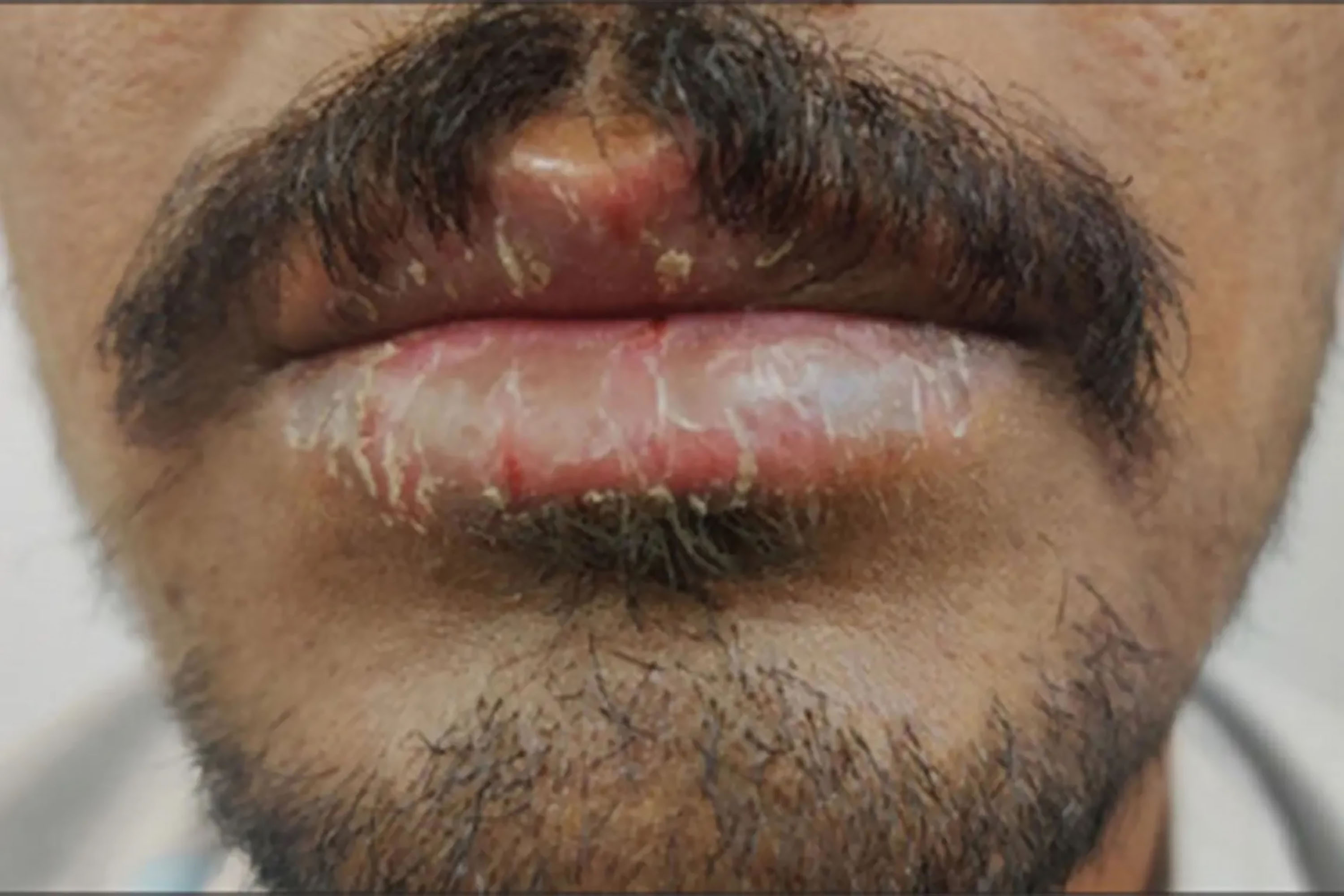 Can You Get Psoriasis on Your Lips?