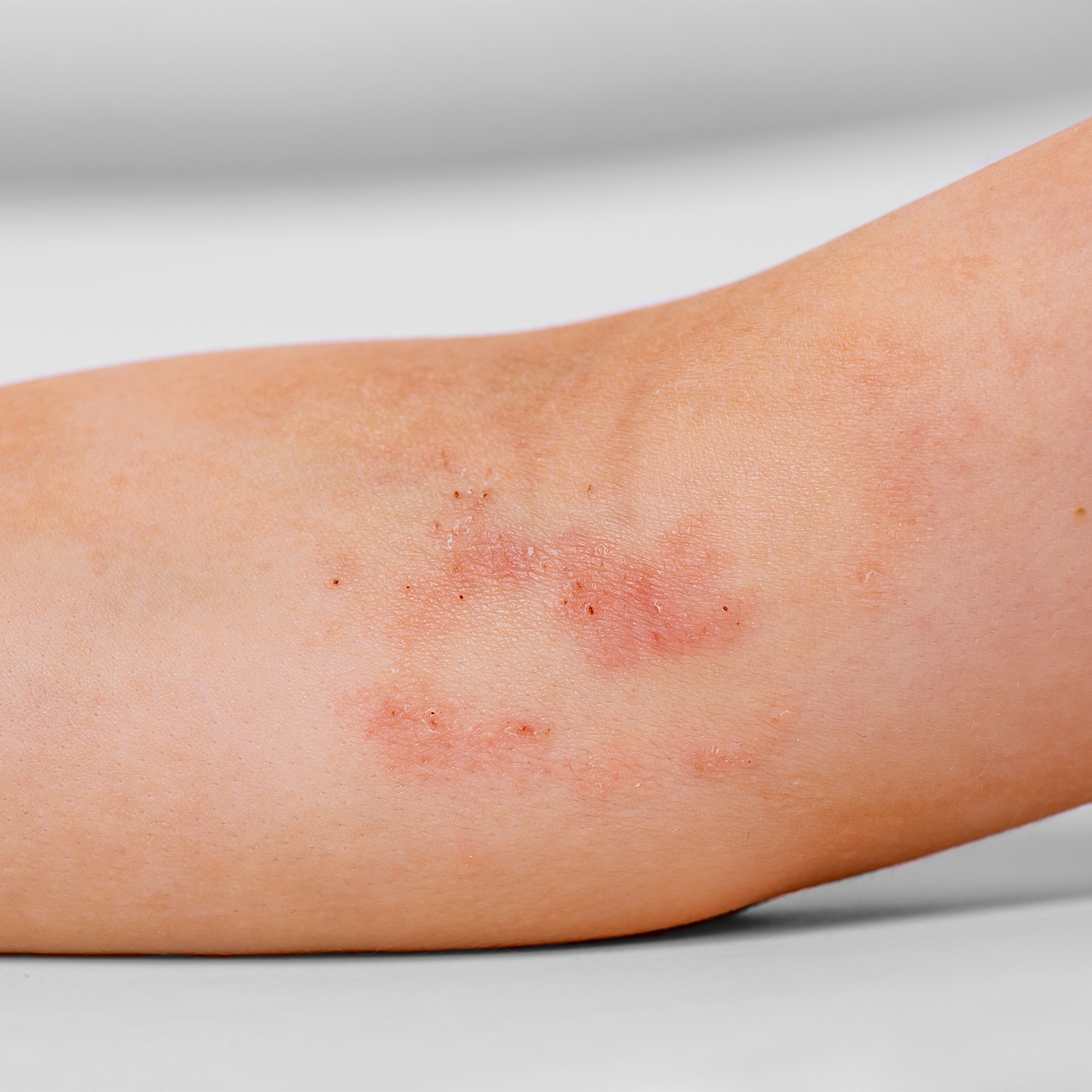 Our Visual Guide to Eczema on Skin of Color