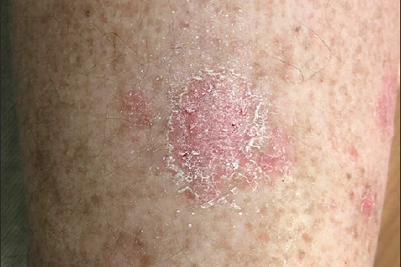 Auspitz Sign: Causes, Symptoms, and Treatment Strategies