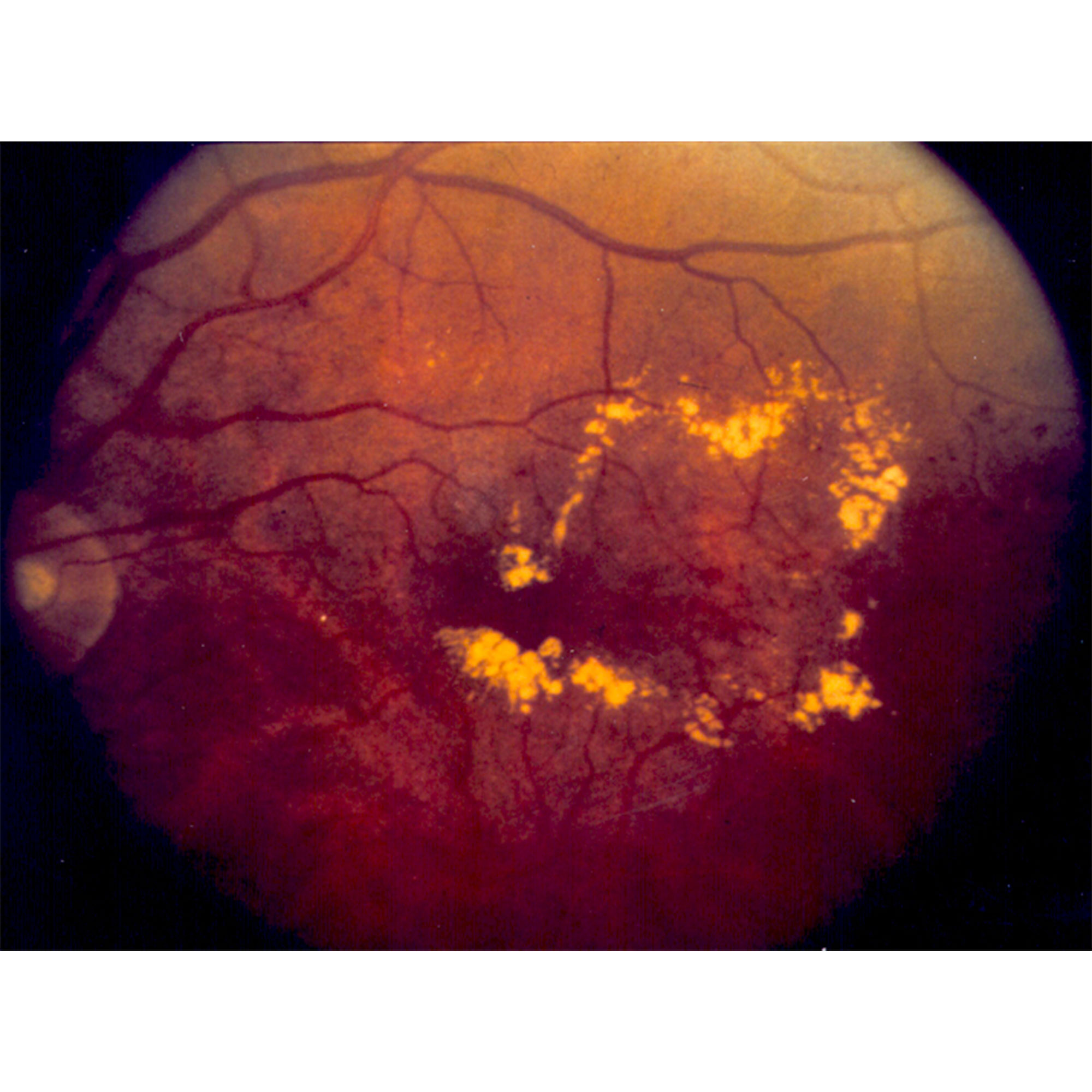 DME Complications: Eye Strain, Vision Loss & Treatment Side Effects