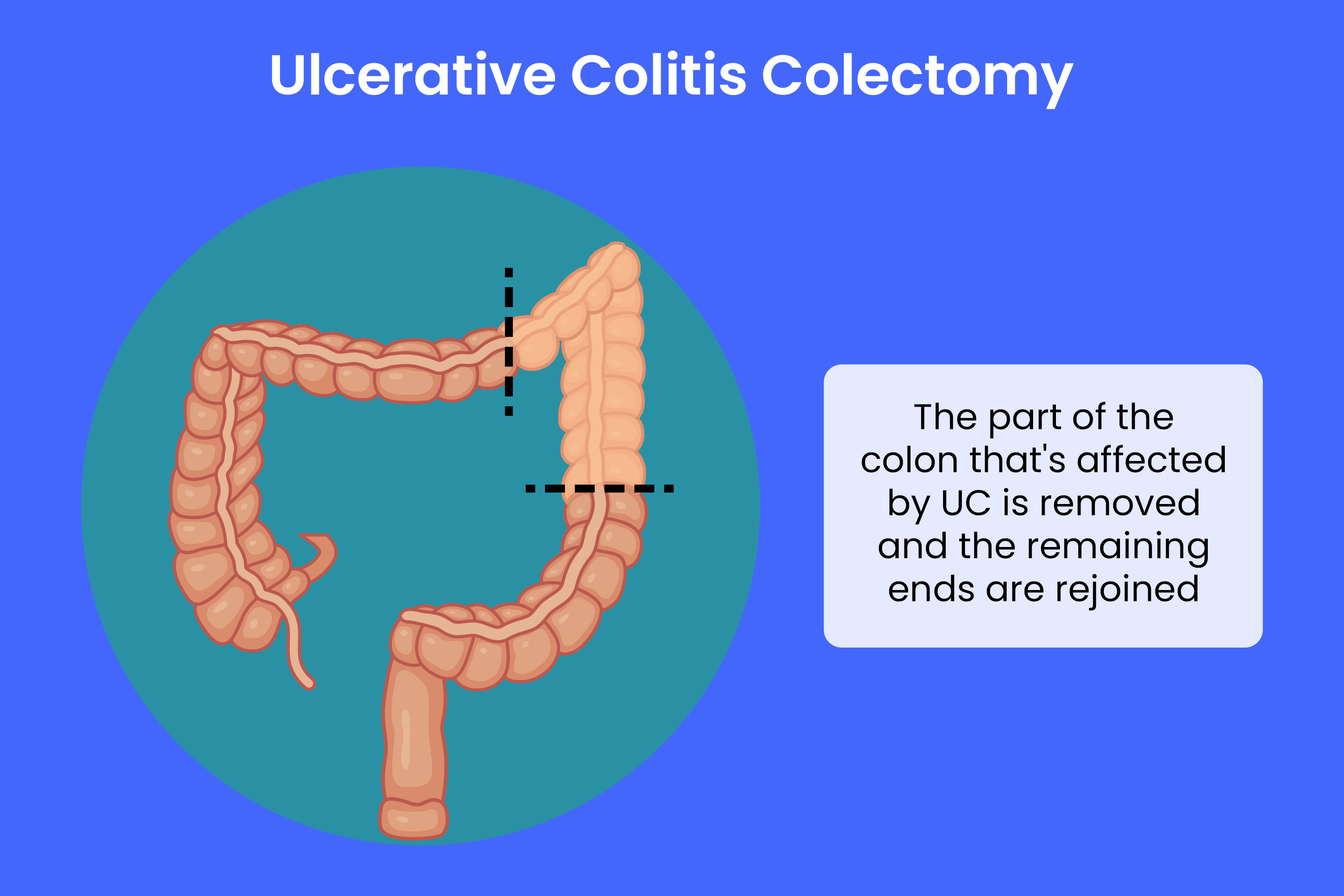 Parts Of Colon