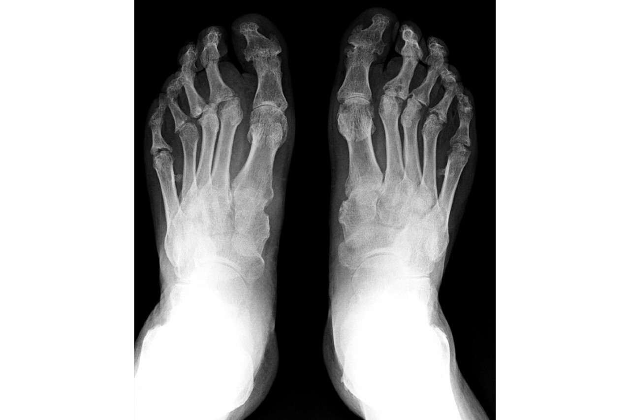Types of Psoriatic Arthritis
