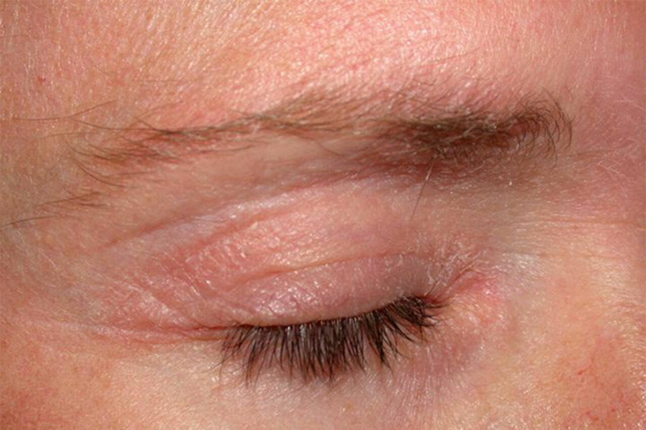 Psoriasis and Eyes: What You Need to Know