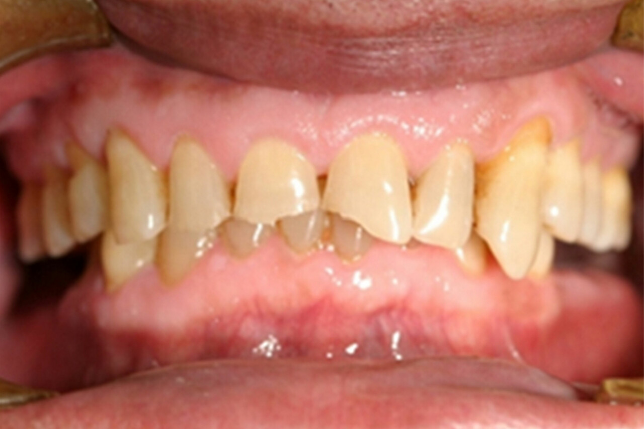 How Can Acid Reflux Affect the Teeth?