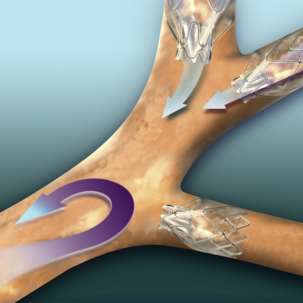 Is Endobronchial Valve Placement for COPD Right for You?