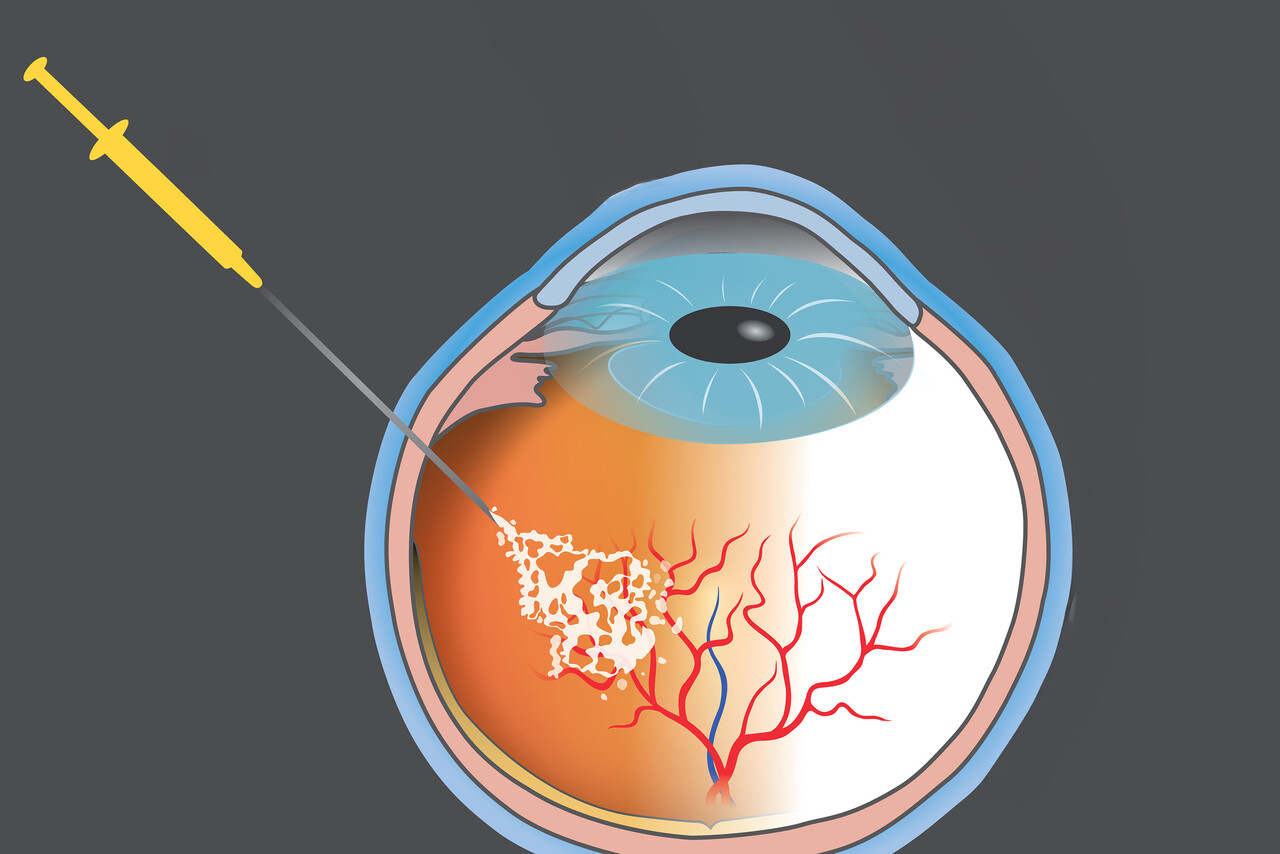 This New DME Drug Shows Promise in Phase 2 Clinical Trial Results