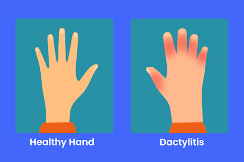 Psoriatic Arthritis and Dactylitis (Sausage Digits): What’s the Link?
