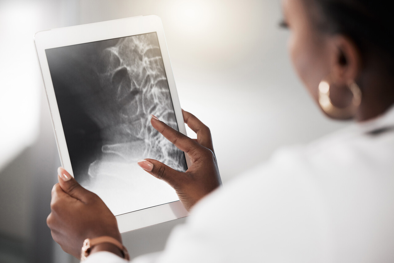 Osteoporosis Compression Fractures: Symptoms, Causes, and Treatment