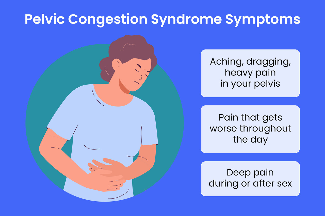 What is Pelvic Congestion Syndrome (PCS)?